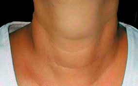 Pseudopseudo Hipoparatireoidismo Hypoparathyroidism : Definition,